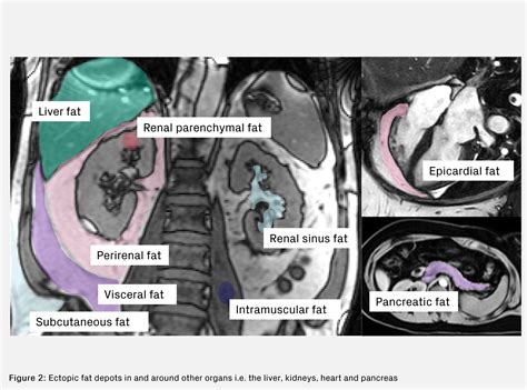 Underneath The Lost Kilos Using Mri Based Body And Muscle Composition Measurements To