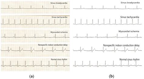 Ijerph Free Full Text Convolutional Neural Network Based Ecg Assisted Diagnosis For Coal Workers