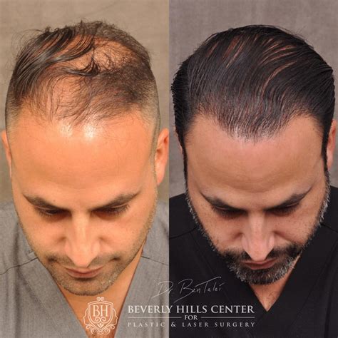 Hair Transplant And Hairline Lowering Before And Afters Beverly Hills