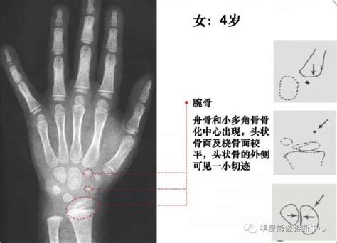 骨龄闭合图左手骨骺线闭合图片如何看懂骨龄片第6页大山谷图库