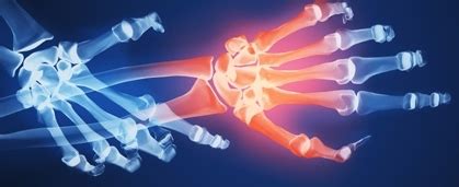 Trigger Finger Surgery Trigger Finger Treatment