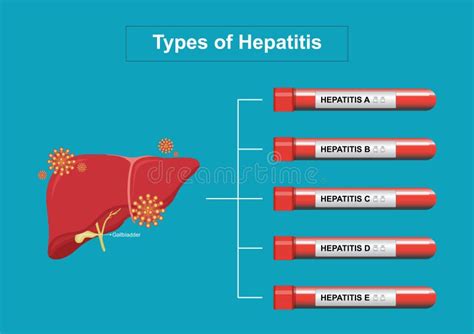 Types Of Hepatitis Hepatitis Is An Inflammation Of The Liver Stock