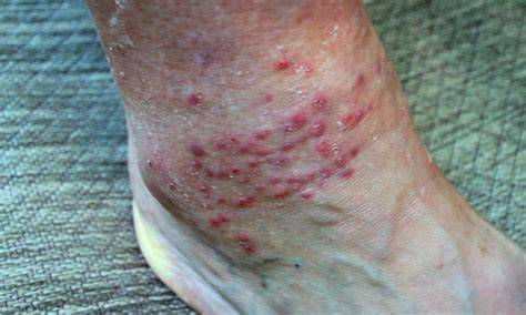 Chigger Bites Vs Bed Bug Bites