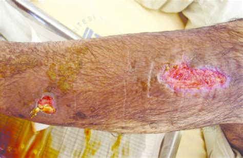 Pyoderma Gangrenosum Before Treatment Of Hairy Cell Leukemia On The
