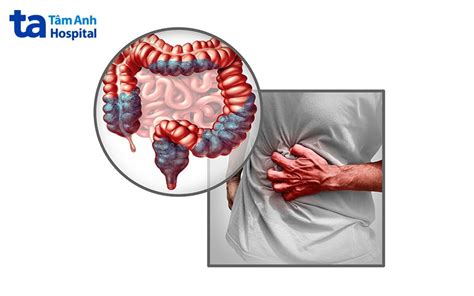 Đau Quặn Bụng Nguyên Nhân Dấu Hiệu Và Cách Phòng Ngừa