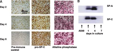 A Positive Pro Sp C And Alkaline Phosphatase Staining Of Human Atii