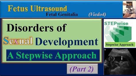 Fetus Ultrasound Disorders Of Sexual Development Part2 Youtube