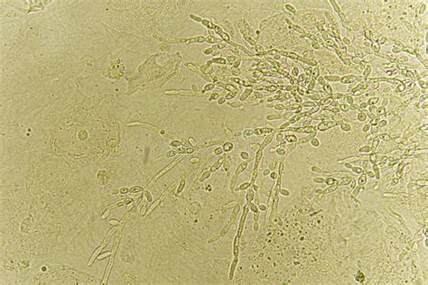 Pseudohyphae And Budding Yeast Cells In Patient Urine Stock Image