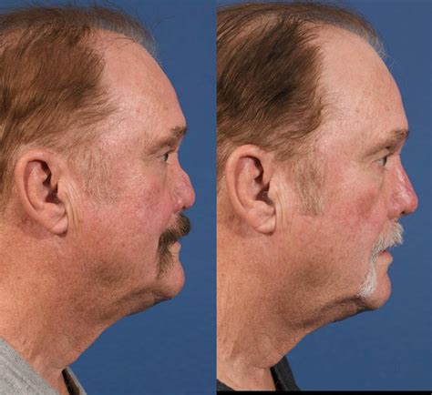 Rhinoplasty Before And After 17