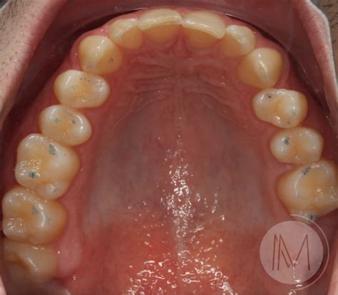 Caso Clínico Nº 4 Clínica Dental Marta Morales En Córdoba