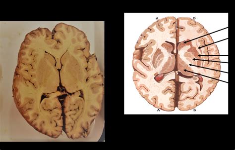 Horizontal View Of The Brain Diagram Quizlet