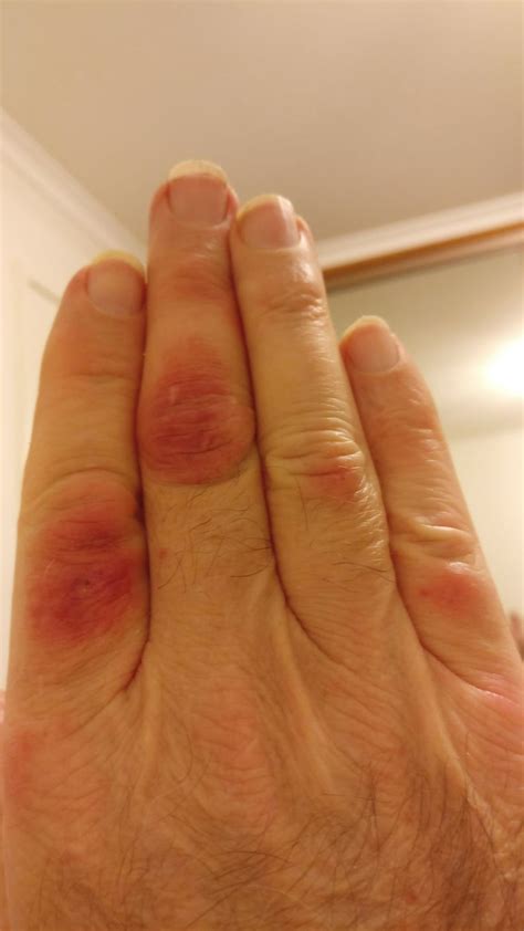 Finger Lesions Then Joint Swelling And Now Rashes Rdermatologyquestions