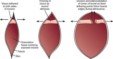 Component Separation For Complex Abdominal Wall Reconstruction And