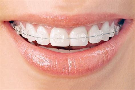 What Are Ceramic Invisible Braces Clear Braces Orthodontics Sydney