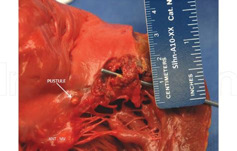 Figure 1 From Septic Embolism In Endocarditis Anatomic And Pathophysiologic Considerations