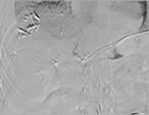 December 2019 Procedure Ir Venogram Procedure Hepatic Arterial
