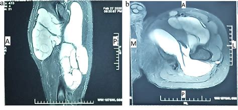 Mri Showing Intramuscular Hydatid Cyst With Multiple Daughter Cysts In