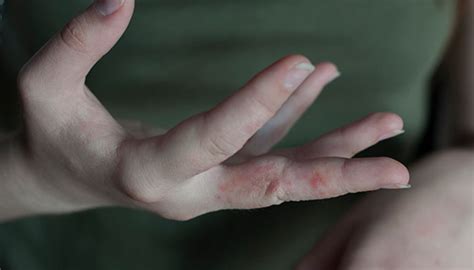 Giardiasis Johns Hopkins Medicine