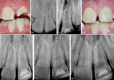Types Of Teeth Fractures