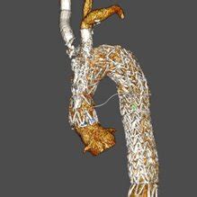 Postoperative CT Scan Months After Surgery Download Scientific Diagram