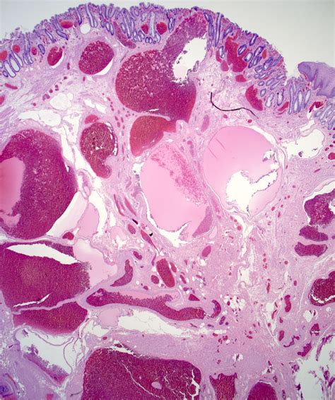 Thrombosed Hemorrhoid Histology