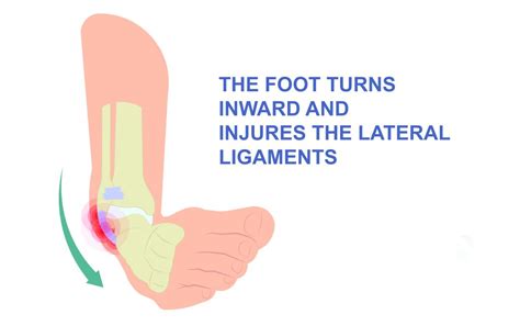 Ankle Sprain Nhs Inform
