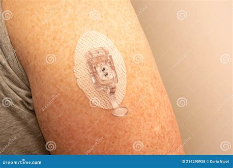 Cgm Continuous Glucose Monitoring Sensor Installation On The Upper