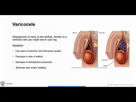Varicocelectomy Procedure