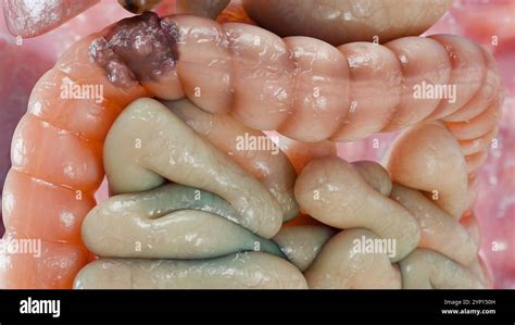 Colorectal Cancer Malignant Tumor In Intestine Endoscope Inside Colonoscopy Gut Intestine