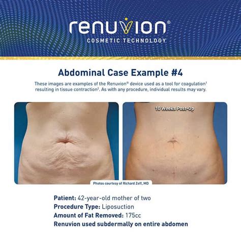 Renuvion® A Minimally Invasive Approach To Skin 42 Off