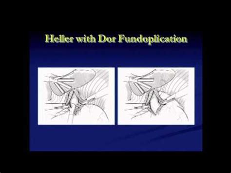 Video Symposium Re Operation For Failed Heller Myotomy YouTube