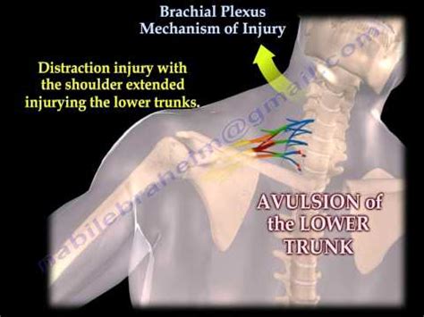 Brachial Plexus Mechanism Of Injury Everything You Need To Know Dr