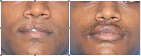 Best Cleft Lip Revision Surgery Everything You Need To Know
