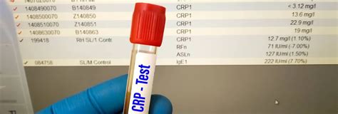 Crp Test Normal Range Purpose And Results Explained
