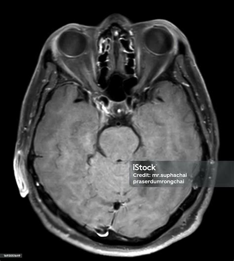 Mri 뇌 스캔 축 방향 평면은 뇌졸중 질환 뇌종양 및 감염으로 뇌 질환을 감지합니다 0명에 대한 스톡 사진 및 기타 이미지