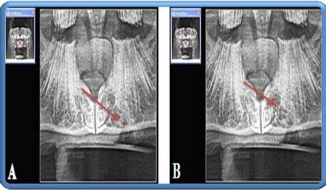 A Densitometric Analysis For Rabbit Group I On Day 15 B