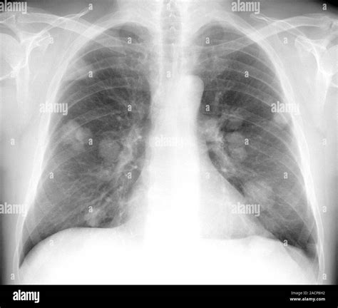 Secondary Lung Cancers X Ray Of The Chest Of A 60 Year Old Male