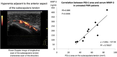 Sat0527 Quantitative Evaluation Of The Shoulder Inflammation In Polymyalgia Rheumatica By Power