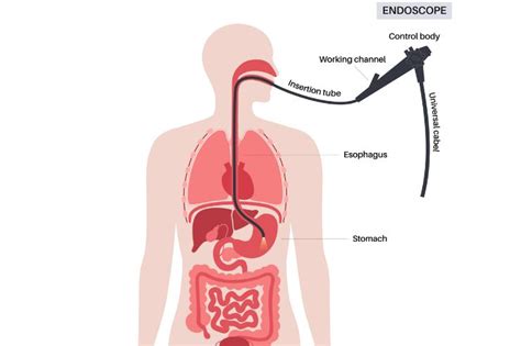 Endoscopy Malaysia Procedure Types What To Expect