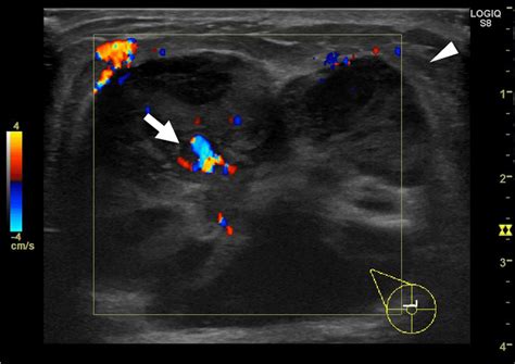 Ultrasonography A 47‐mm Irregular Hypoechoic Mass With Heterogeneous Download Scientific