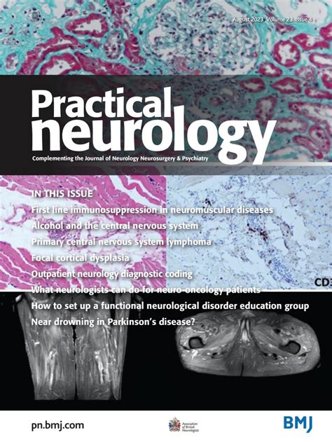 Mena Farag On Linkedin Trigeminal Neuropathy From Root Entry Zone