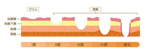 胃潰瘍｜病気の知識｜公平病院｜埼玉県戸田市