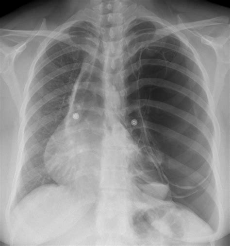 Findings Pa Chest Shows An Expanded Hyperlucent Left Lung With