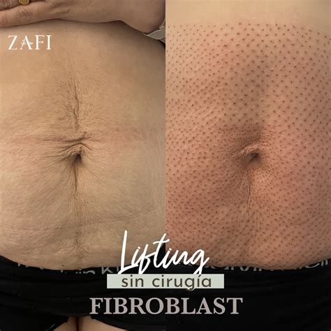 Fibroblast O Plasma Pen Piel Suelta Abdomen Zafi Estetica