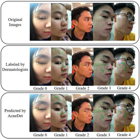 Automatic Acne Object Detection And Acne Severity Grading Using