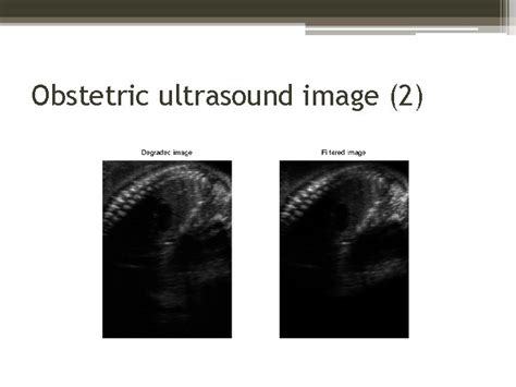 Estimation Of Point Spread Function Psf In Ultrasound