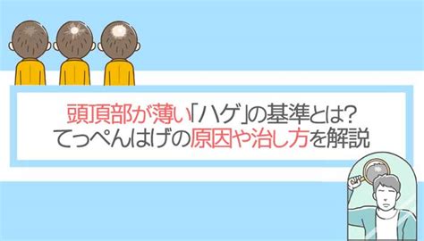 頭頂部が薄い「ハゲ」と言われる基準とは？てっぺんはげの原因や治し方を解説 吉祥寺でaga・薄毛治療ならスーパースカルプ発毛センター吉祥寺