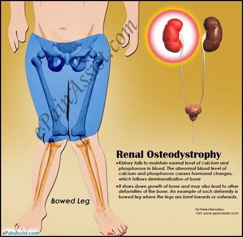 Renal Osteodystrophy Definition Treatment Causes Symptoms Diagnosis