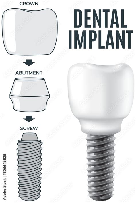 Realistic White Dental Implant And Human Tooth Dentistry Medicine And