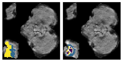Github Avalouisefinneganbrain Tumor Segmentation Brats Challenge